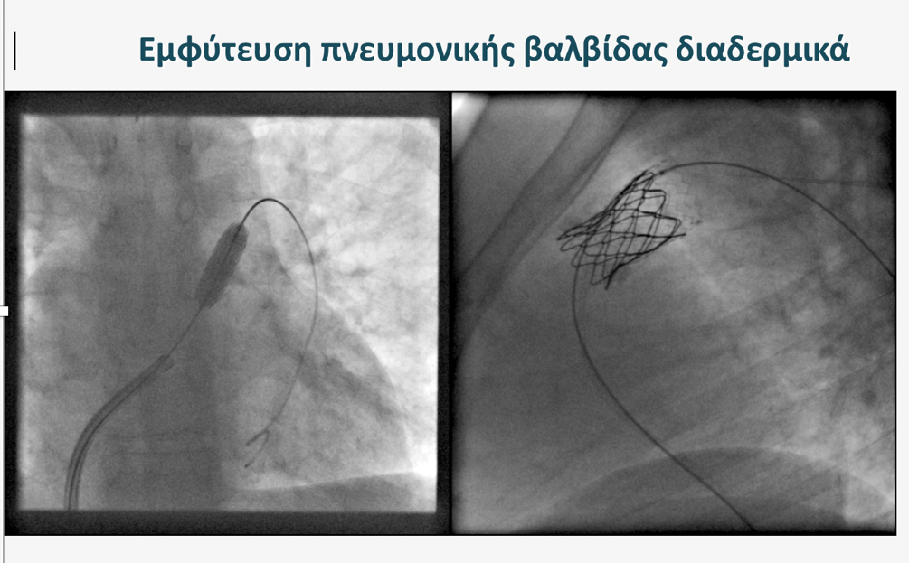 Τετραλογία Fallot (ToF) - Childrens Heart
